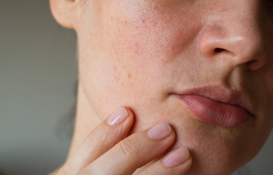 Why Is My Skin So Oily All of A Sudden? | Epicuren Discovery Blog